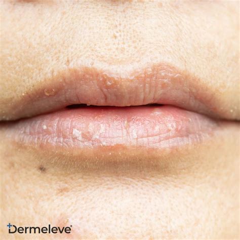 Dermeleve® On Linkedin Eczema On Lips Lip Dermatitis Triggers And