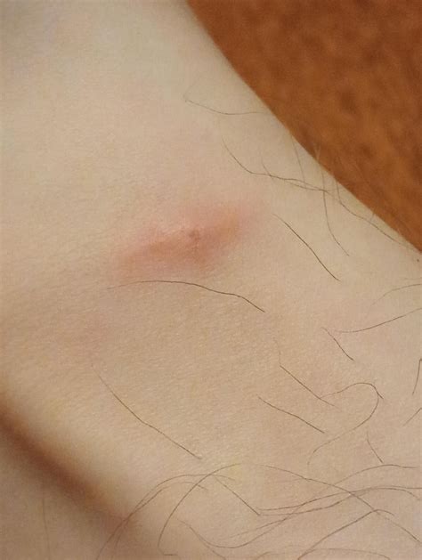 What Is This Bug Bite R Bugbites