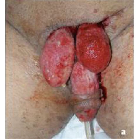 A Granulation Tissue After Debridement And Local Care B