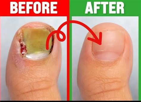 The Most Insightful Stories About Toenail Fungus Medium