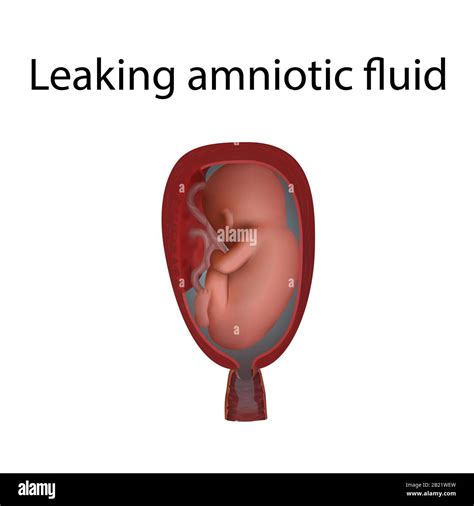 What Does Amniotic Fluid Look Like
