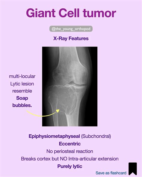 Osteoclastoma Symptoms Orbital Bone Tumors Ento Key