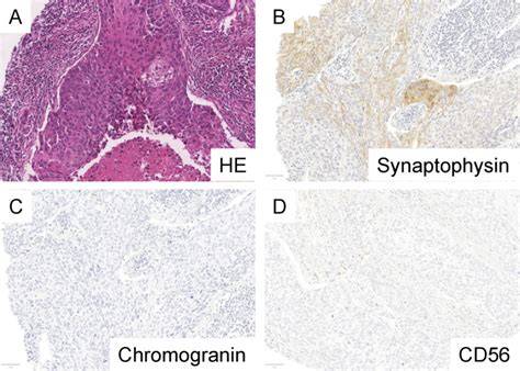 Role Of Synaptophysin Chromogranin And Cd56 In Adenocarcinoma And