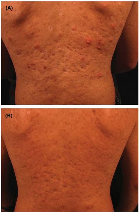 Atrophic Acne Scars On The Back Before A And 1 Month After