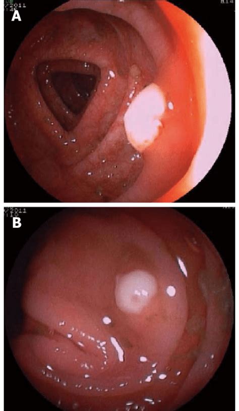Colonoscopy Images Showing Two Polyps 4 And 6 Mm In Size In The Right