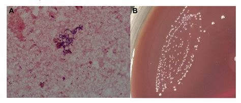 Figure 2 From Liver Abscess Due To Streptococcus Constellatus In An