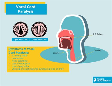 Build A Info About How To Repair Damaged Vocal Chords Aidcreative