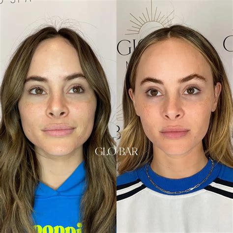 Botox And Dysport In Costa Mesa Ca Anti Aging Injections