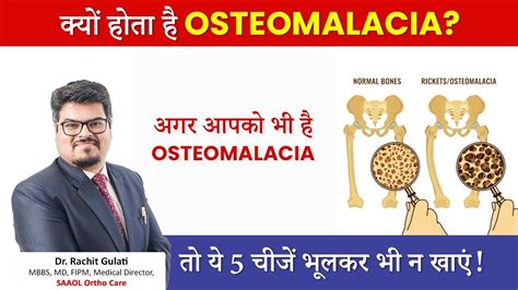 Vitamin D Deficiency Causes Osteomalacia 5 Foods To Avoid For