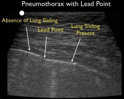 Thoracic Ultrasonography Critical Care Clinics