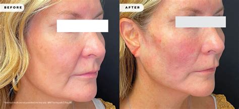 Mint Pdo Threads Irvine Non Surgical Facelift Concierge Aesthetics