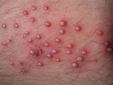 Folliculitis Definition Of Folliculitis