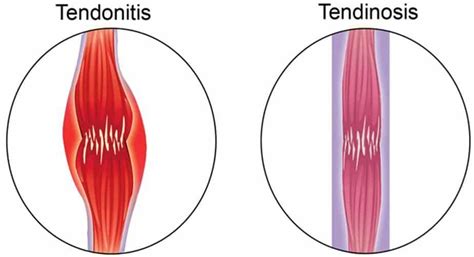 Tendonitis Causes Symptoms And Treatment Options