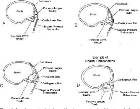 Figure 1 From Peroneal Tendon Dislocations Semantic Scholar