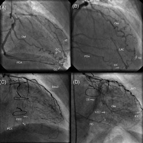 Pdf Importance Of Collateral Circulation In Coronary Heart Disease