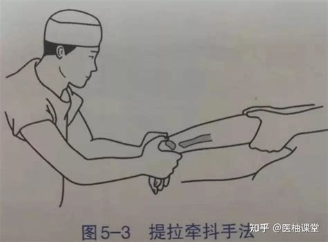 骨折的整复手法，全面总结到位！ 知乎