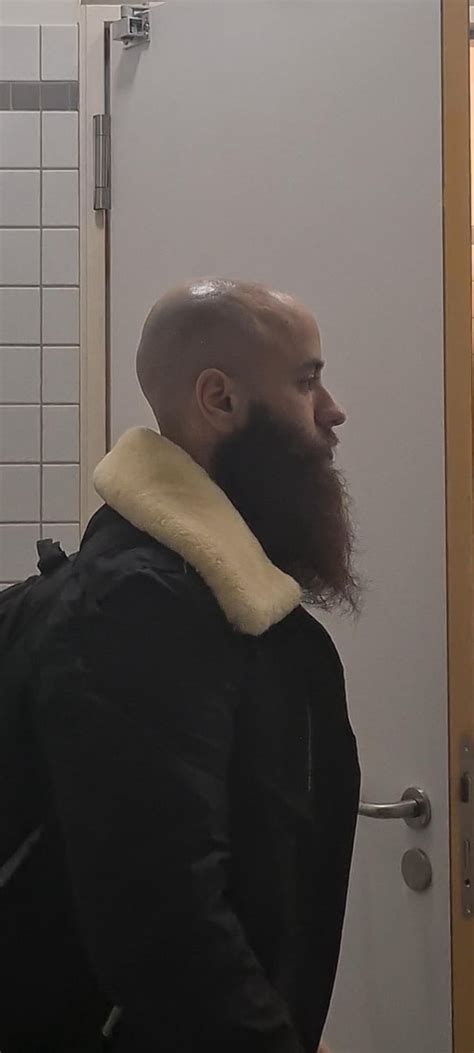 Is My Maxilla Flat Is It Average Recessed 🤔 Do I Need Surgery R