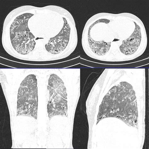 Chest Radiography Showed Bilateral Bibasal Subpleural Reticular