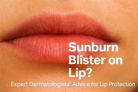 Sunburn Blister On Lip Dermatologists Expert Advice