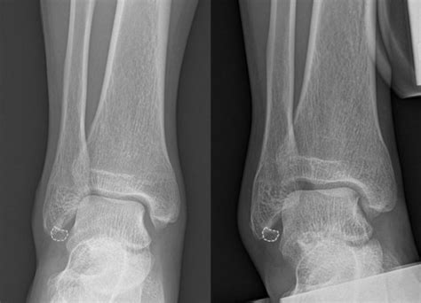 Presence Of Subfibular Ossicle Does Not Affect The Outcome Of