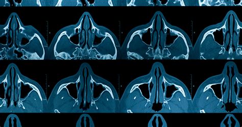 Sinusite O Que é Sintomas E Tratamento Cuf