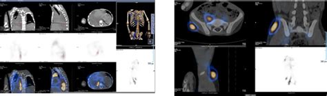 Figure 3 From Case Report Of Generalized Lymphatic Dysplasia With