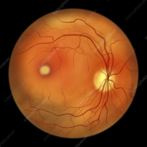 Best Vitelliform Macular Dystrophy Illustration Stock Image F037