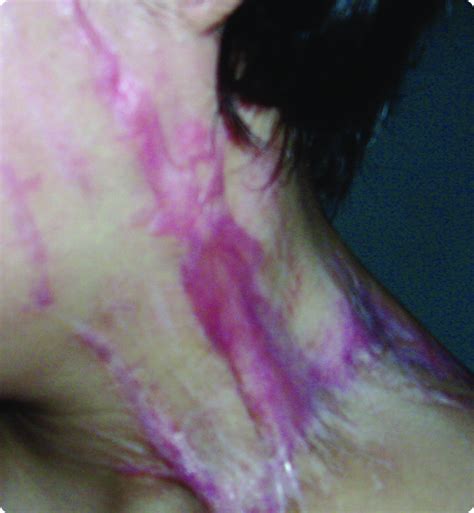 The Same Wound Two Months After Epithelialisation Download