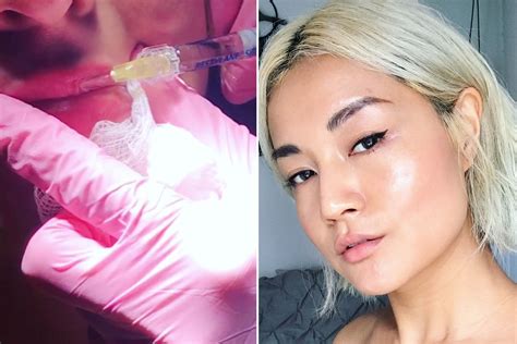 Can You Wear Makeup After Lip Fillers Saubhaya Makeup
