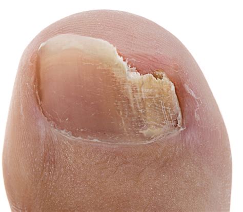 Green Nail Syndrome Pseudomonas 2026