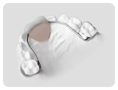 How To Remove Space Maintainer At Yang Perez Blog