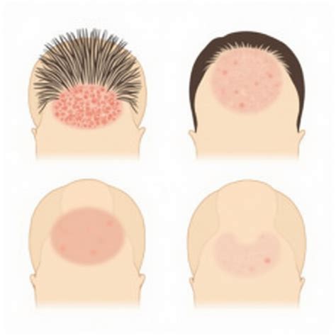 Create An Illustration That Includes Examples Of Androgenic Alopecia