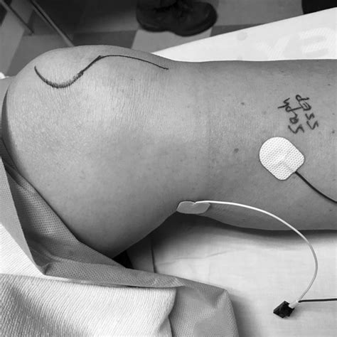 Intraoperative Photograph Showing Placement Of Saphenous Ssep