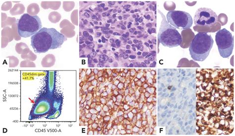 Plasma Cell Leukemia