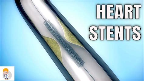 What Is Heart Stent Types Uses And Cost Benefits Youtube