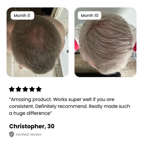 Hair Loss Treatments South Africa Andbam