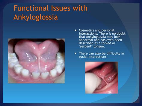 Ppt Ankyloglossia Powerpoint Presentation Free Download Id2078965