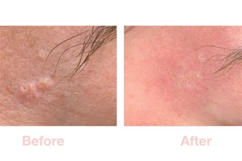 Sebaceous Hyperplasia