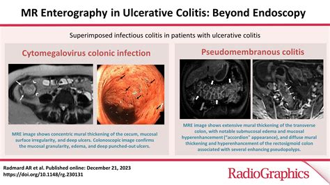 Ischemic Colitis Endoscopic Classification At Ethel Waggener Blog