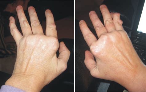 Rheumatoid Arthritis Finger Bumps At Dollie Guth Blog