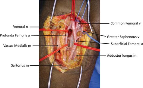 Medisonru Superficial Femoral Artery Common Femoral Femoral Artery