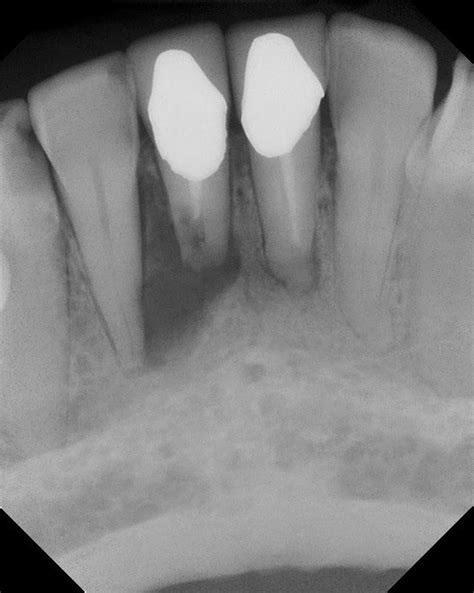 Testing The Limits Of Endodontic Surgery