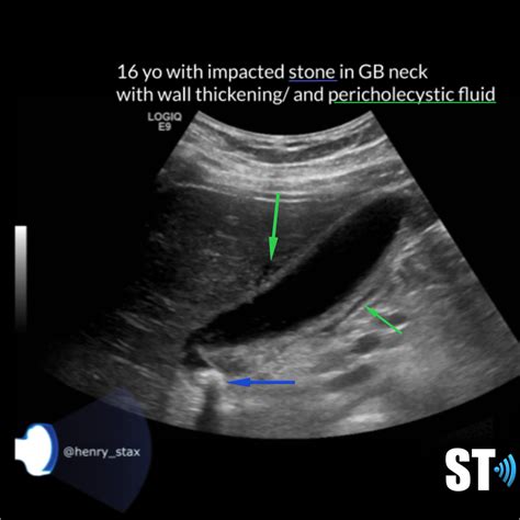 Abnormal Gallbladder Ultrasound