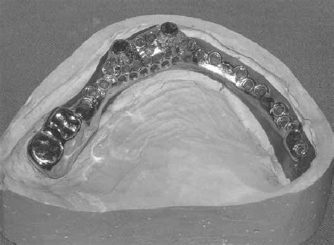 Metal Base Of The Resection Prosthesis With Outer Opened Telescope
