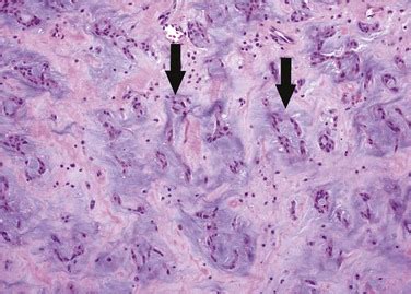 Cardiac Tumors Radiology Key