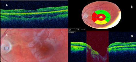Post Operative Fd Oct Scan Showing Resolution Of The Macular Schisis