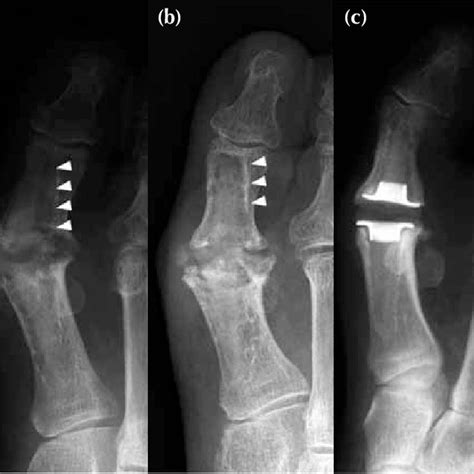 Pdf Flexible Hinge Silicone Implant With Or Without Titanium Grommets