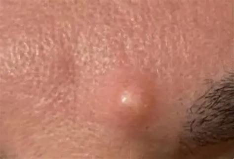 Quistes Sebáceos Pqp