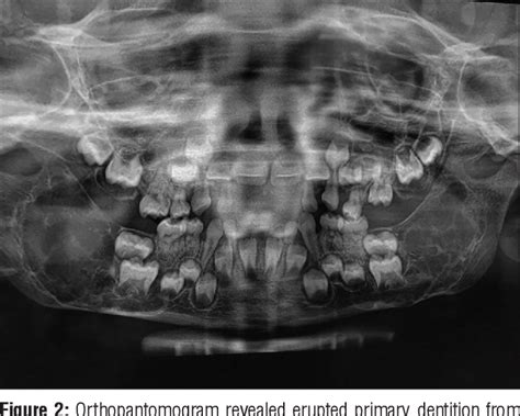 Figure 2 From Ramon Syndrome A Rare Form Of Cherubism Semantic Scholar