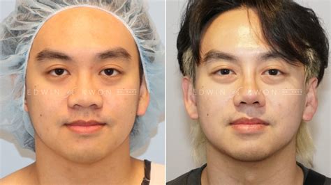 Asian Rhinoplasty Edwin Kwon Md Facs